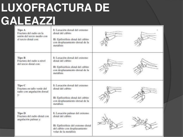 Fracturas diafisiarias y tercio distal de radio y cubito