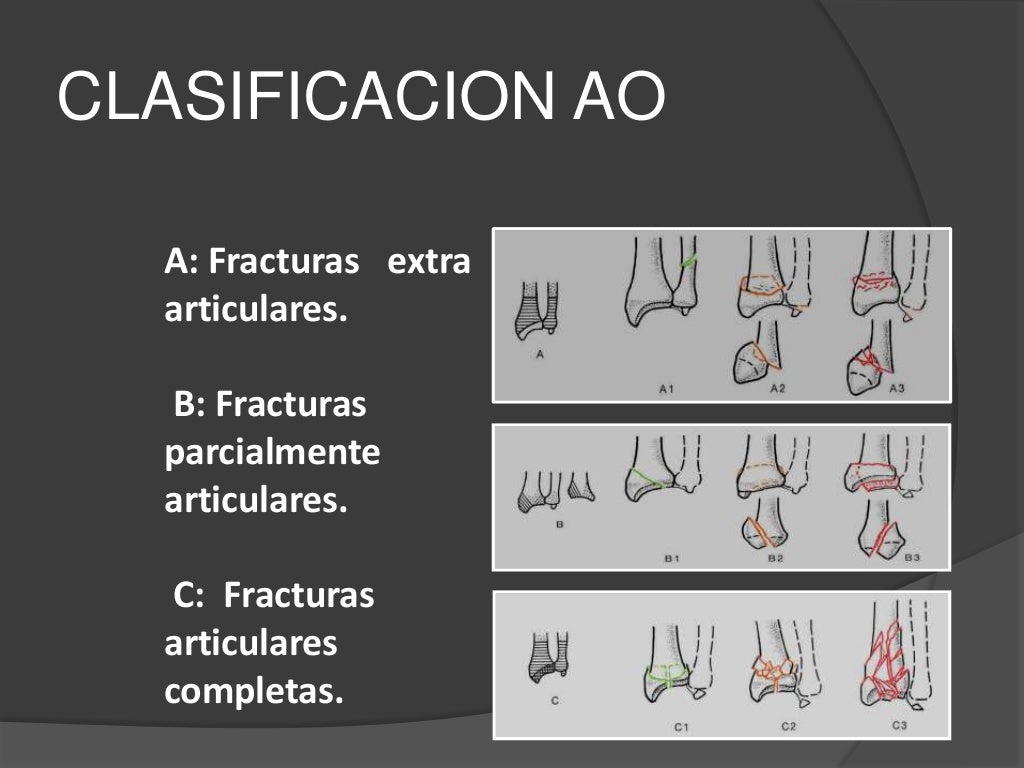 Fracturas diafisiarias y tercio distal de radio y cubito