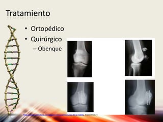 Fracturas en miembros inferior | PPTX