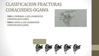 ANATOMIA Y FRACTURAS DE ESCAPULA Y ACROMION.pptx