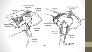 ANATOMIA Y FRACTURAS DE ESCAPULA Y ACROMION.pptx
