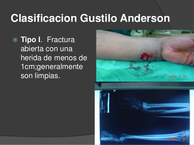Clasificacion De Gustilo Y Anderson Fracturas Expuestas – JSOPE