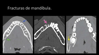 Fracturas faciales | PPTX