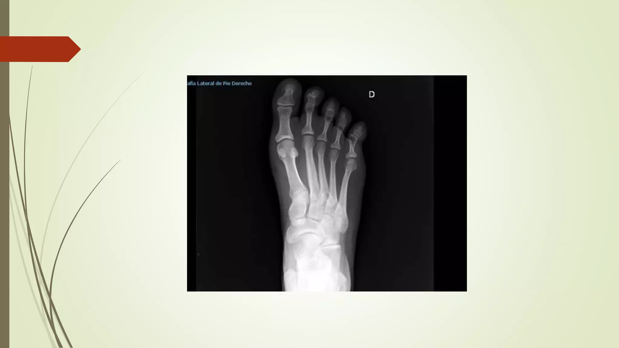 Fracturas falanges | PPTX