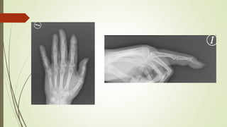 Fracturas falanges | PPTX