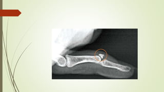 Fracturas falanges | PPTX