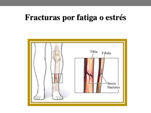 Generalidades de Fracturas