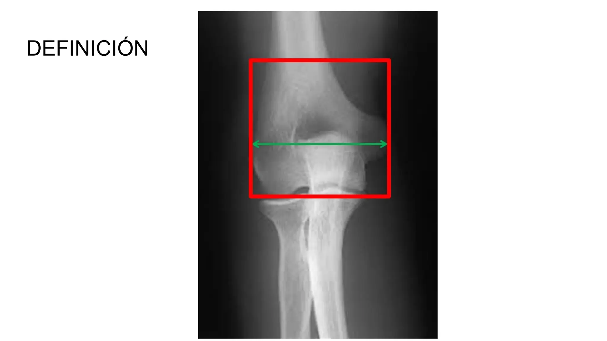 FRACTURAS HUMERO DISTAL revisión -1.pdf