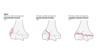 FRACTURAS HUMERO DISTAL revisión -1.pdf