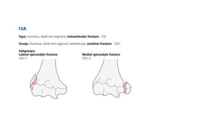 FRACTURAS HUMERO DISTAL revisión -1.pdf