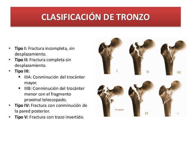 Fracturas intertrocanterias: Clasificación de Tronzo y Tratamiento