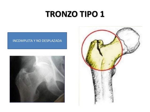 Fracturas intertrocanterias: Clasificación de Tronzo y Tratamiento