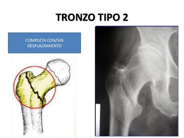 Fracturas intertrocanterias: Clasificación de Tronzo y Tratamiento