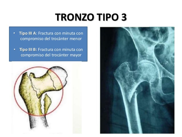 Fracturas intertrocanterias: Clasificación de Tronzo y Tratamiento