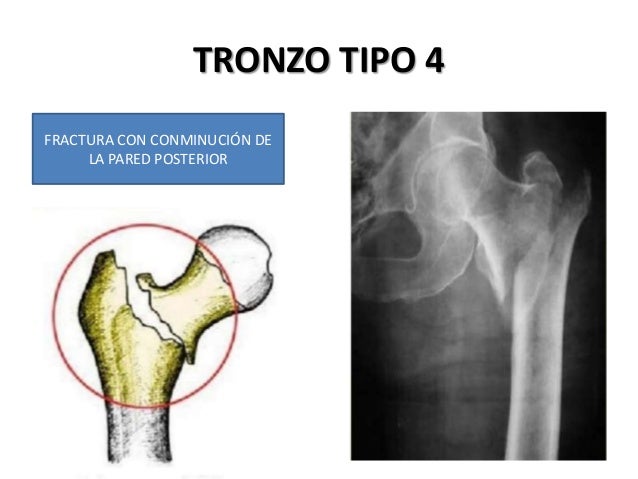 Fracturas intertrocanterias: Clasificación de Tronzo y Tratamiento