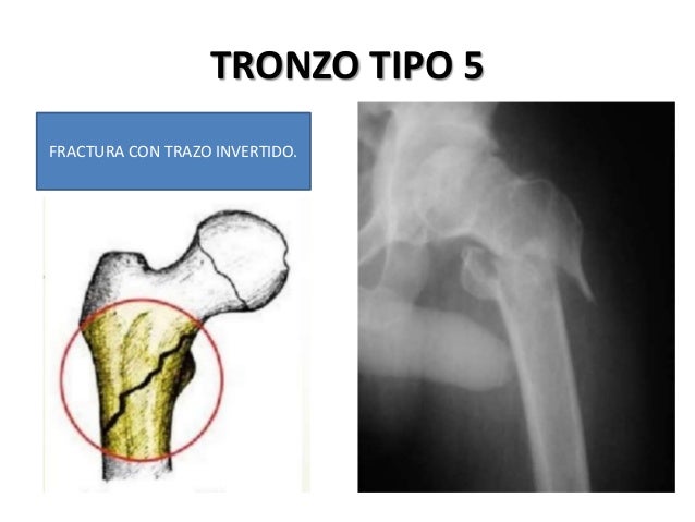Fracturas intertrocanterias: Clasificación de Tronzo y Tratamiento