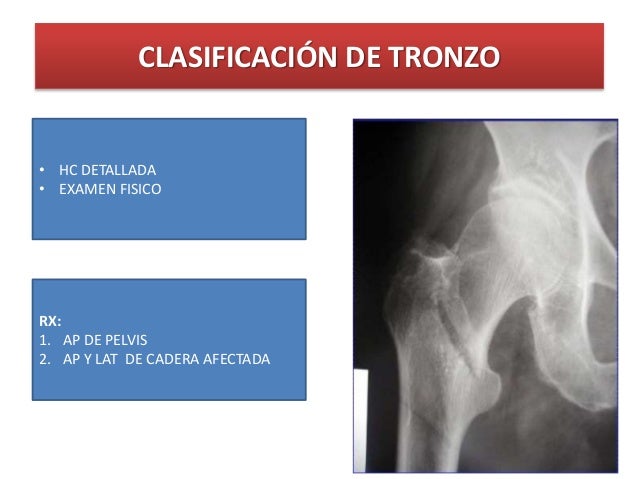 Fracturas intertrocanterias: Clasificación de Tronzo y Tratamiento