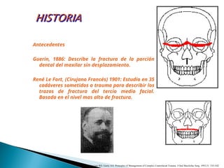 FRACTURAS TRAUMA FACIAL - LE-FORT 2021.ppt