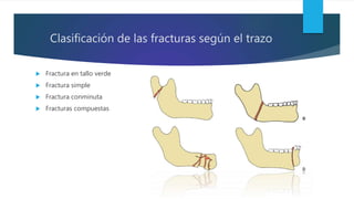 Clasificación De Fractura De Mandíbula