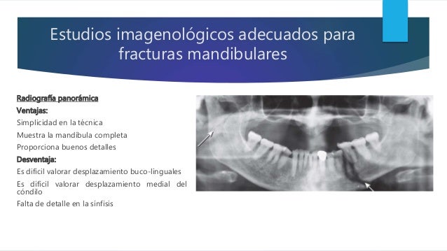 Fracturas mandibulares
