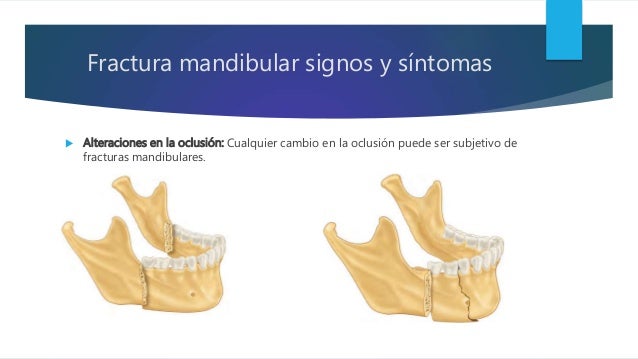 Fracturas mandibulares