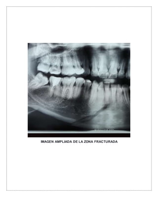 FRACTURAS MANDIBULARES | DOCX