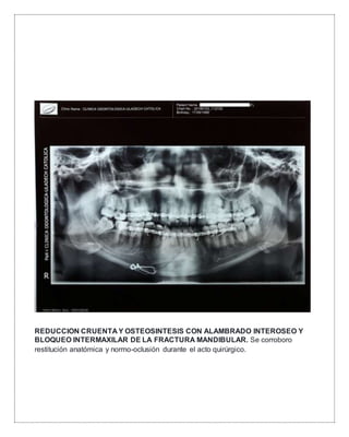FRACTURAS MANDIBULARES | DOCX