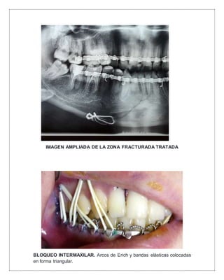 FRACTURAS MANDIBULARES | DOCX