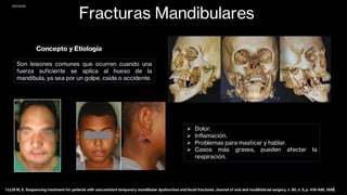 Fracturas Mandibulares y tecnicas de fijacion .pdf