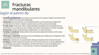 fracturas mandibulares clasificación y etiológia | PPTX