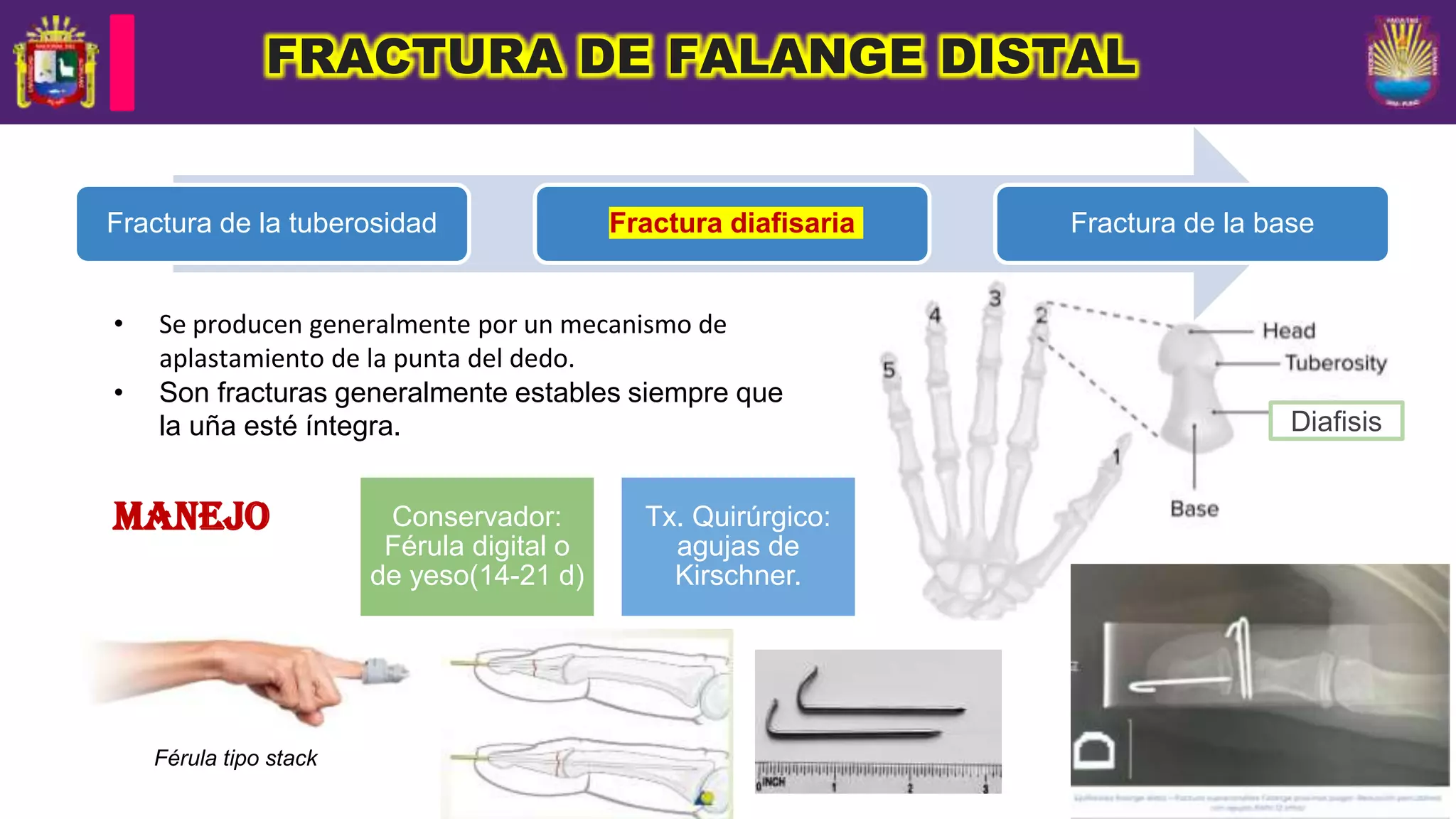 Fractura de MTC y falanges de la mano | PPTX