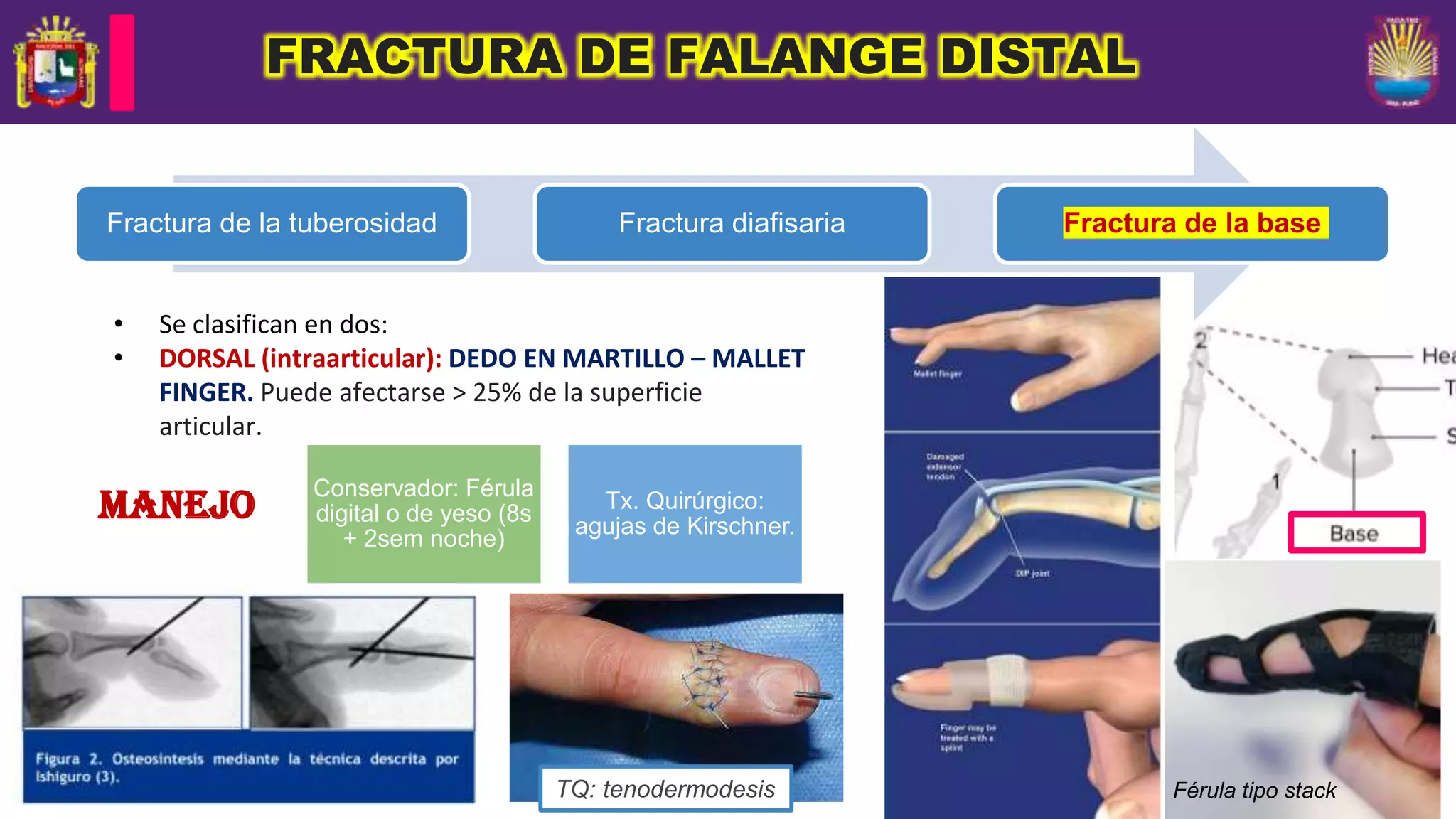 Fractura de MTC y falanges de la mano | PPTX