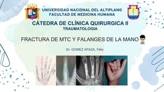 Fractura de MTC y falanges de la mano | PPTX