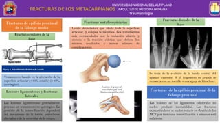 Fractura de MTC y falanges de la mano | PPTX