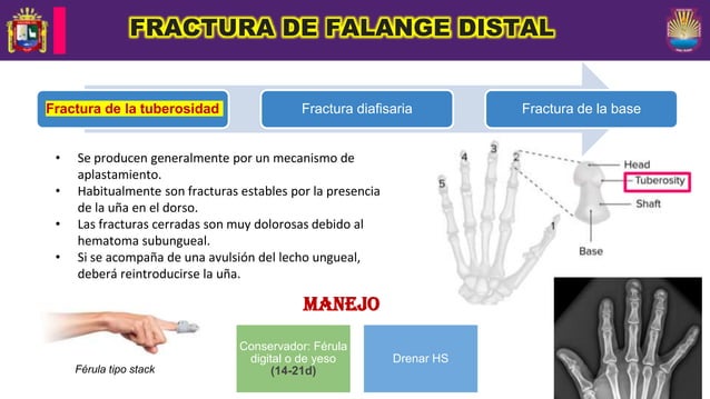 Fractura de MTC y falanges de la mano