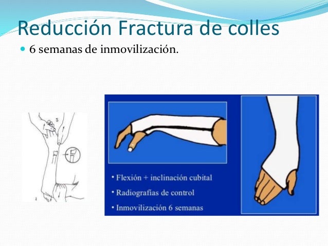 Fracturas de miembros superiores más frecuentes