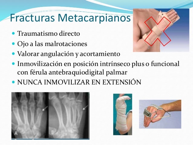 Fracturas de miembros superiores más frecuentes