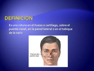Fracturas nasales Dr Gabriel Hinojosa Pardo | PPTX