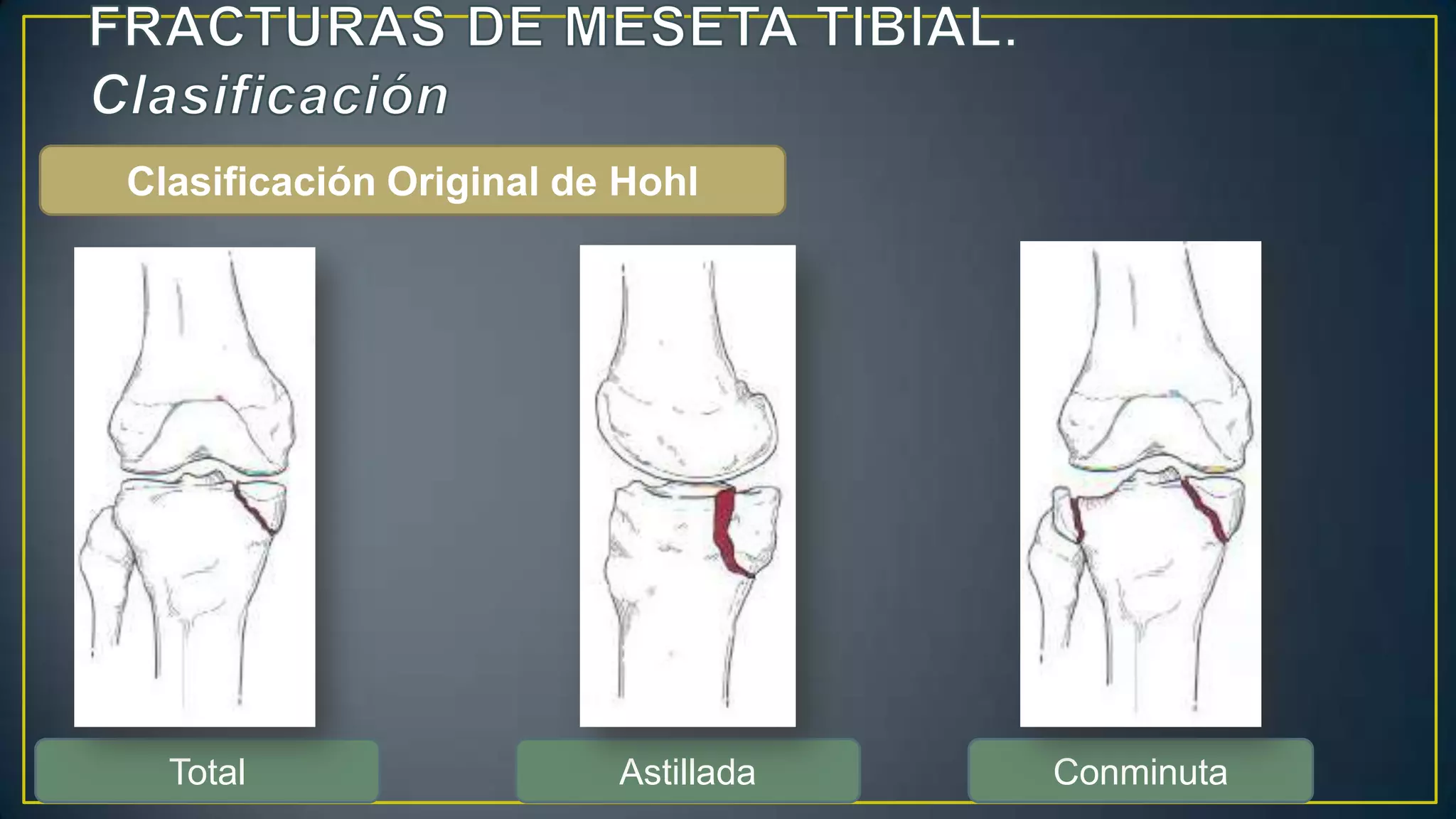 Fracturas proximales de tibia y perone | PPTX