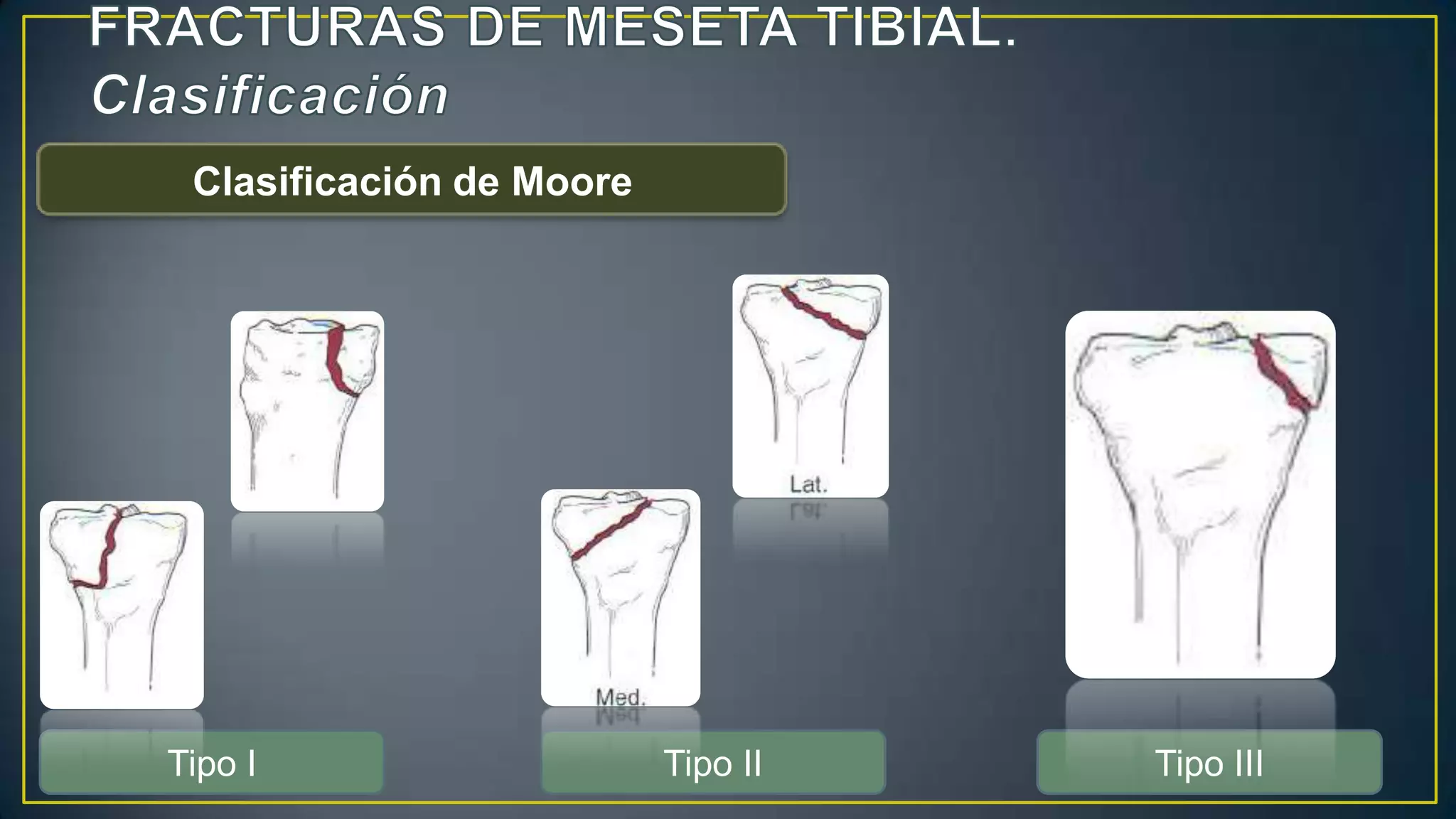 Fracturas proximales de tibia y perone | PPTX