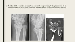 FRACTURAS RADIO DISTAL GENERALIDADES.pptx