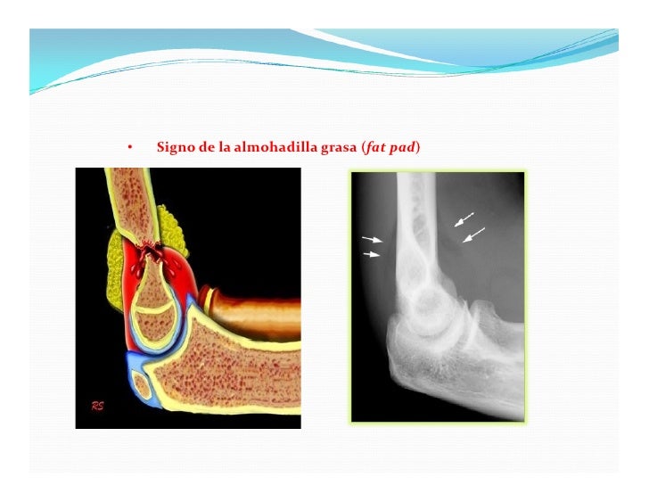Fracturas supracondileas