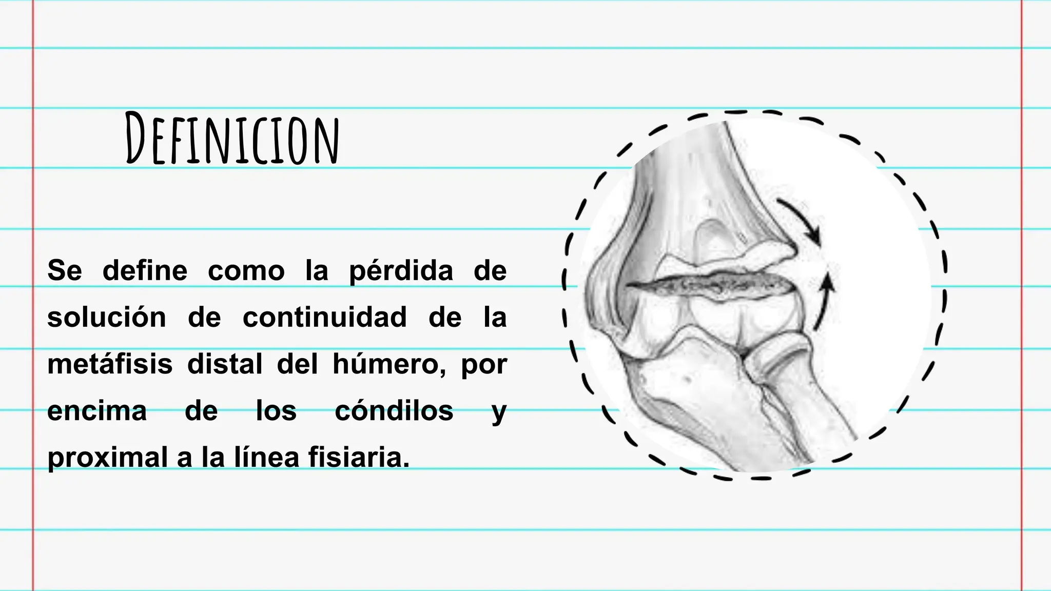 Fracturas supracondilias en el humero distal en niños.pptx