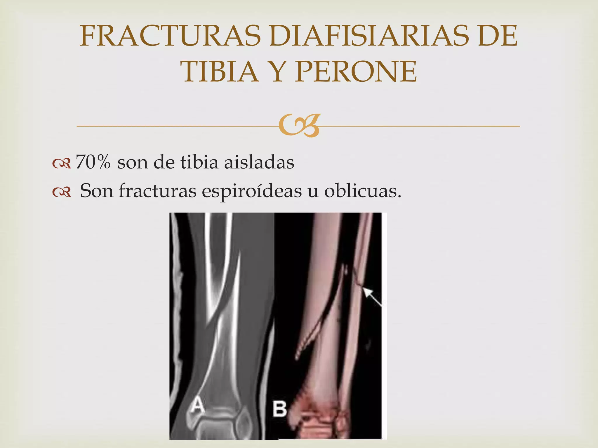 Fracturas de Tibia y peroné | PPT