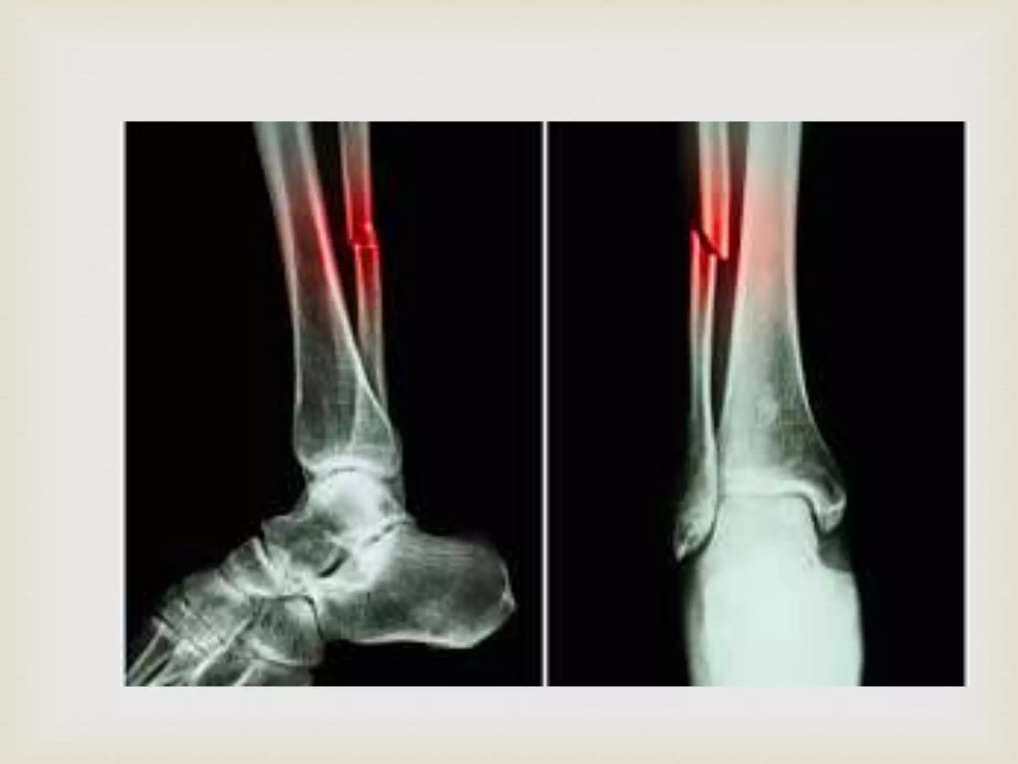 Fracturas de Tibia y peroné | PPTX