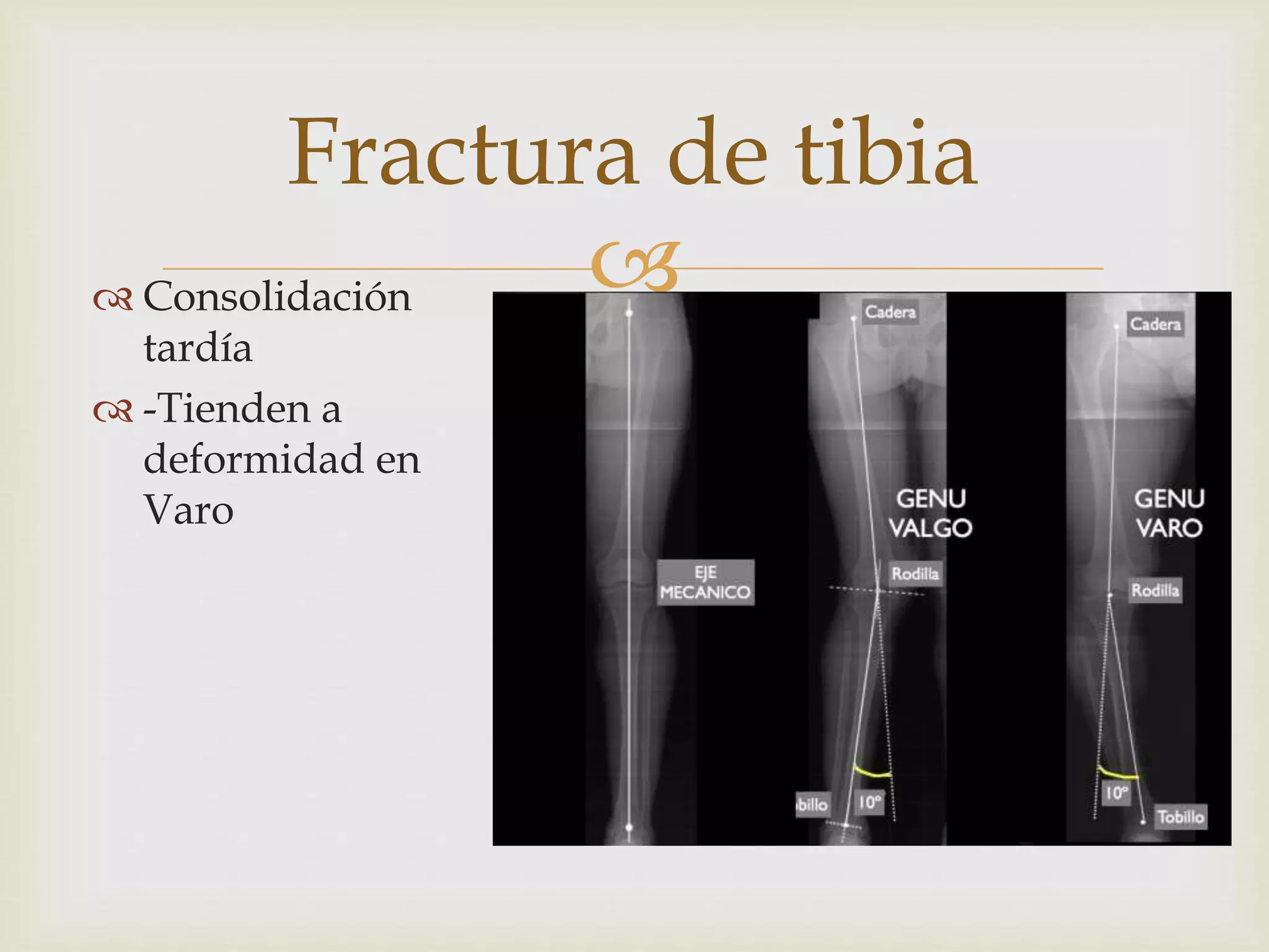 Fracturas de Tibia y peroné | PPTX