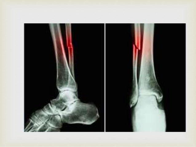 Fracturas de Tibia y peroné