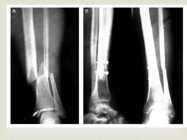 Fracturas de Tibia y peroné