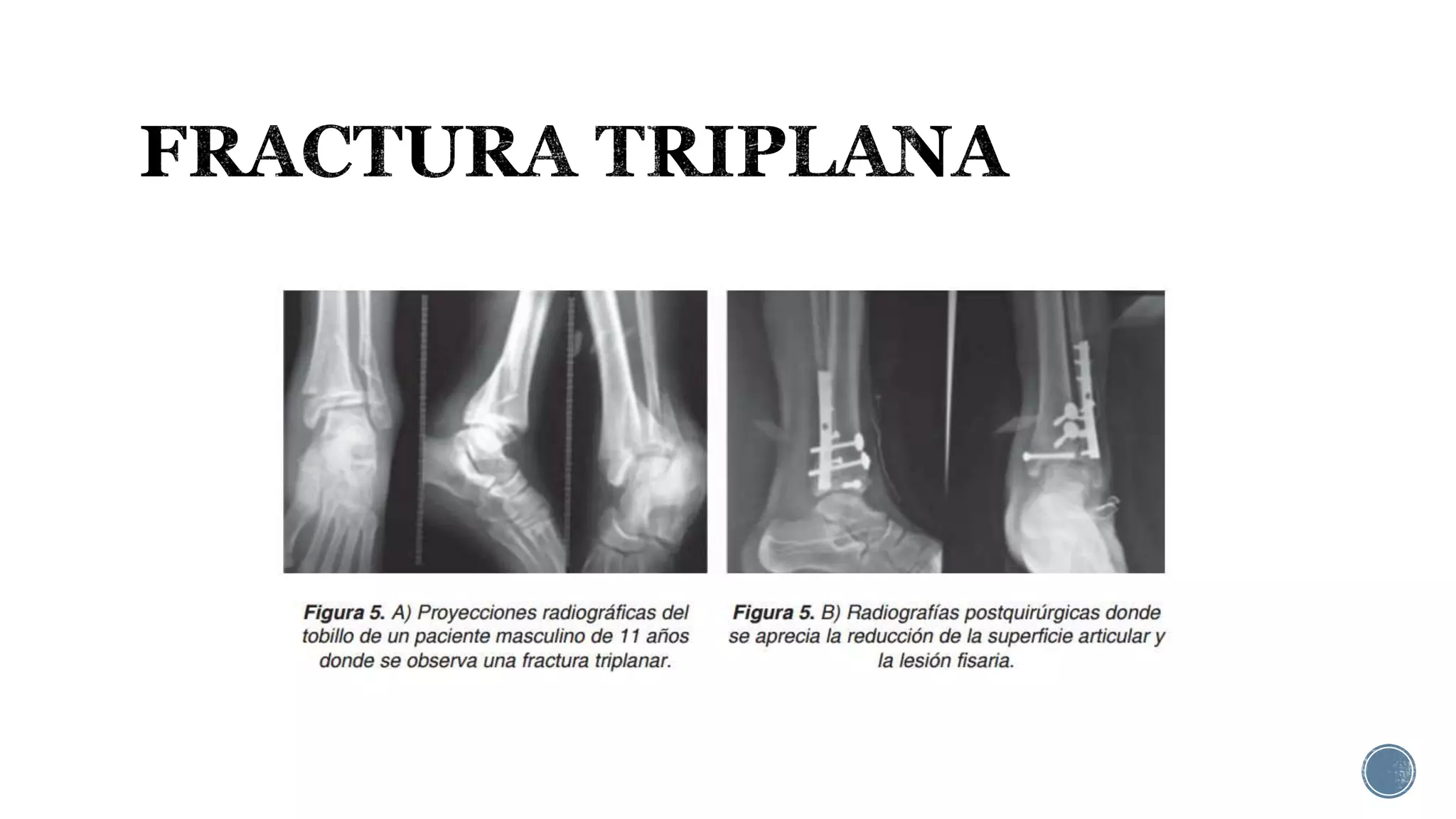 Fracturas de tibia y tobillo en niños | PPTX