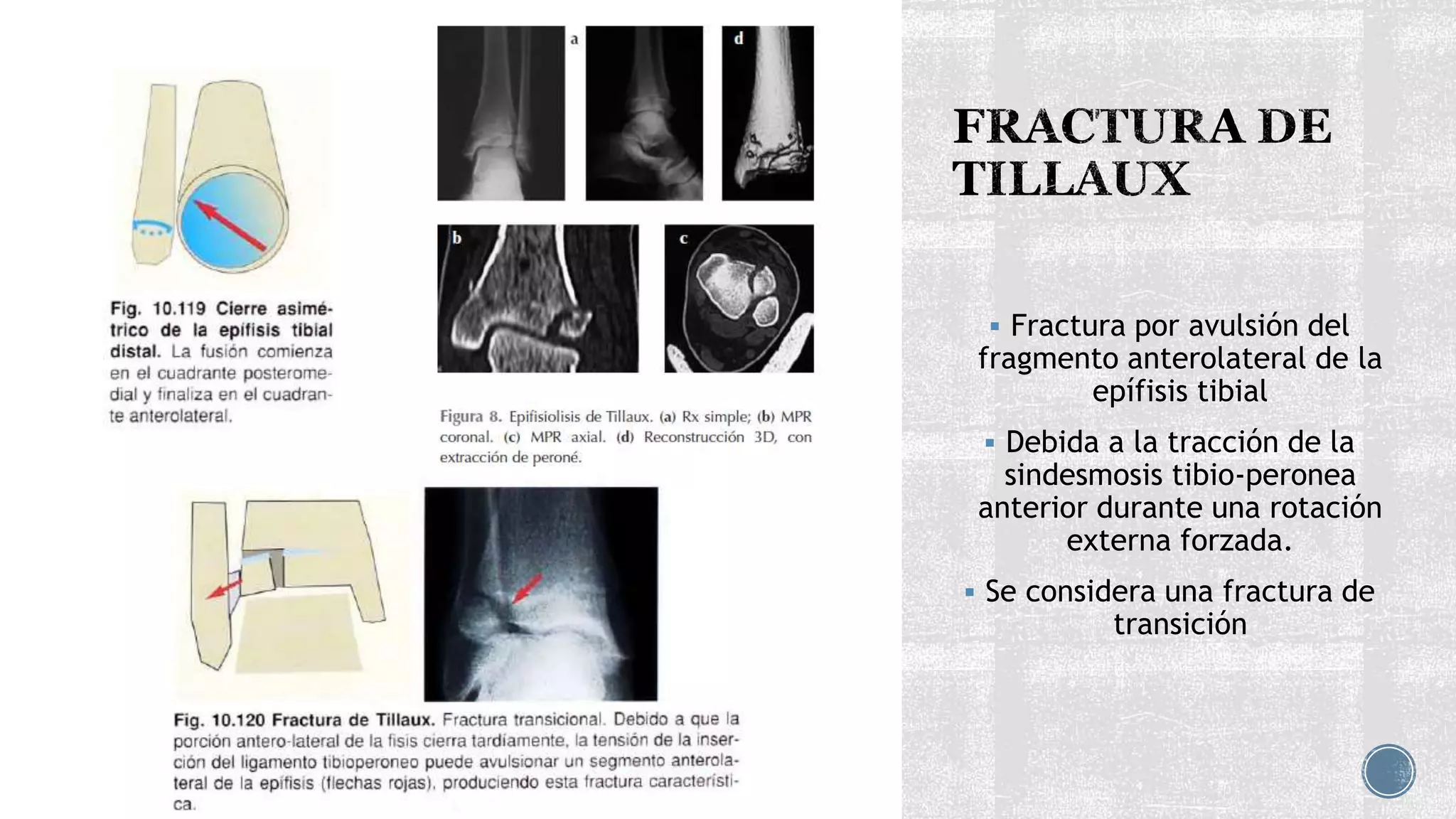 Fracturas de tibia y tobillo en niños | PPTX